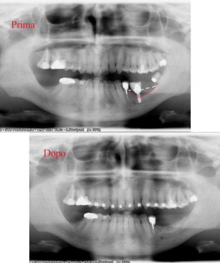 Résorption Osseuse. Comment prévenir la Perte Osseuse | TravelToDentist