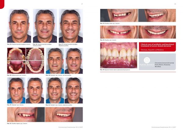 Clinical case Facets: Reconstruction of blunt teeth and closure of the ...